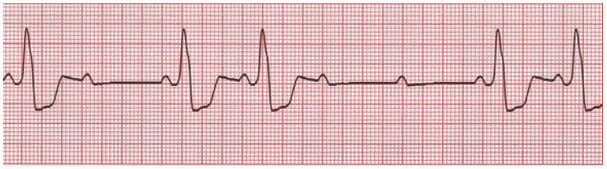 Block nhĩ thất (AV block) trên điện tâm đồ - PGS Hà Hoàng Kiệm