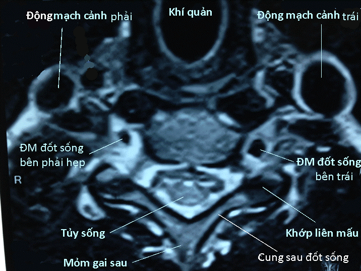 Cách đọc phim MRI (cộng hưởng từ) thoái hóa và thoát vị đĩa đệm cột ...