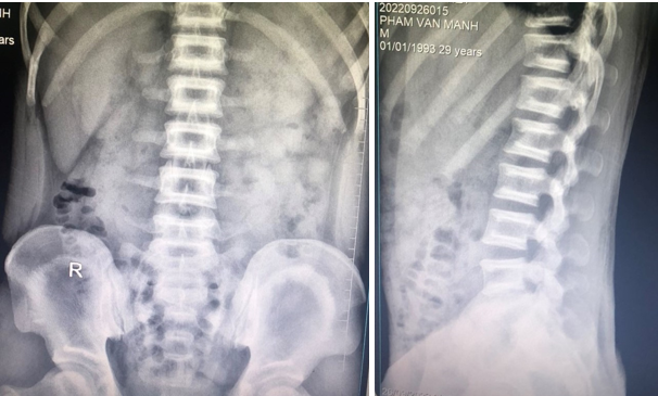 Bệnh xương hóa đá (Marble bone, Osteopetrosis, Albers Schonberg) - PGS ...