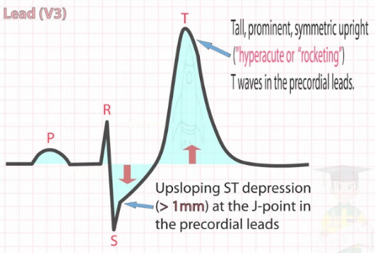 Dấu hiệu De Winter trên điện tim (Một cảnh báo chết người) - PGS Hà ...